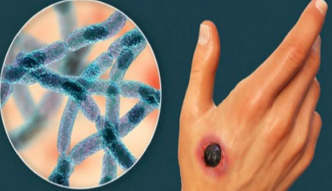 انتشرت في بعض الدول.. أسرار صادمة عن الجمرة الخبيثة | الحكاية